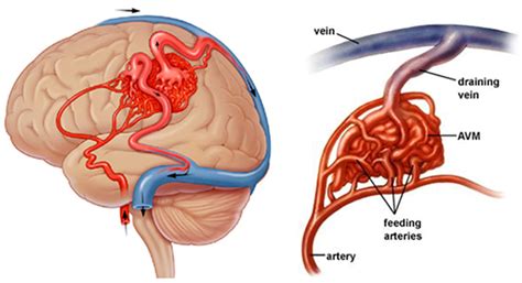 Brain Avm Varicose Veins Vascular Surgeon Stroke Dvt Leg