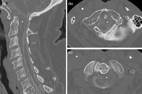 Case 1 Preoperative Ct Myelography Revealed A Sizeable Retro Odontoid Download Scientific