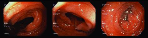 Colonoscopy Showing Ascending Colon Transverse Colon And Descending Download Scientific