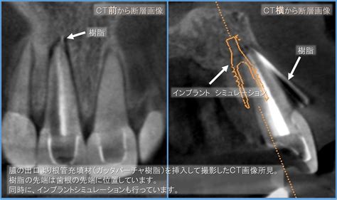 抜歯と同時にインプラント 上前歯