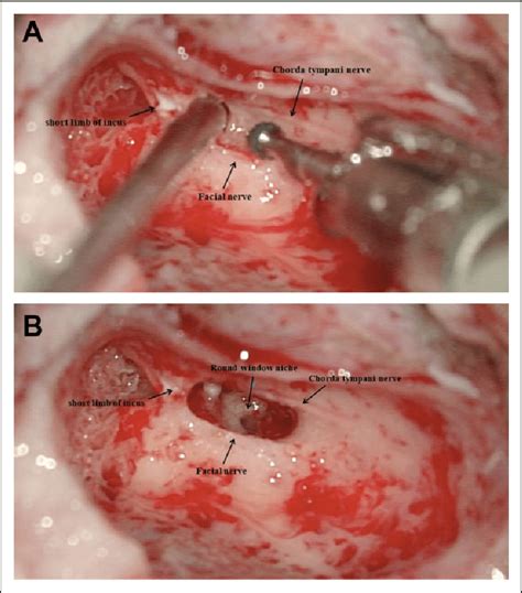 Expose Round Window In The Surgery Of Cochlear Implantation Through