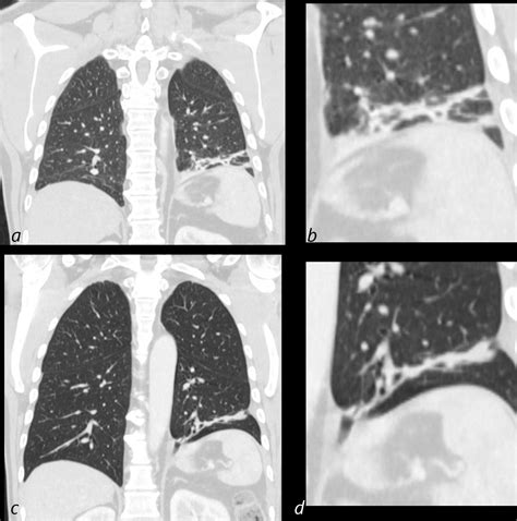 276lu Evolution Of Linear Atelectasis Aka Discoid Atelectasis Aka Platelike Atelectasis Over 3