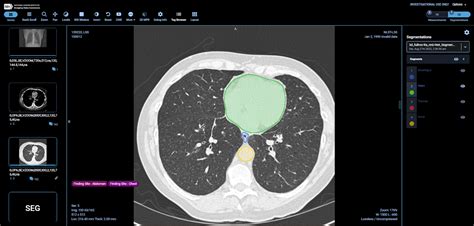 New Paper From The Idc Team Enrichment Of Lung Cancer Computed