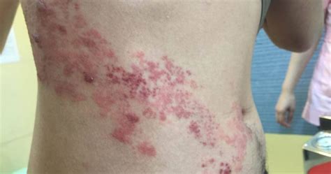 長輩防「皮蛇」接種帶狀皰疹疫苗有額外好處？ 研究：可降失智風險 生活 Ctwant
