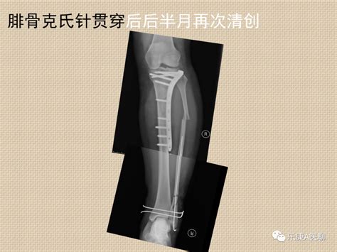 经验分享：开放踝骨折水泥、外固定治疗！ 德医医学 助力医学教育发展！