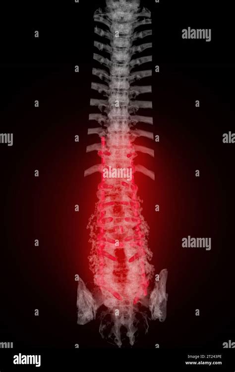 Ct Scan Of Thoracic And Lumbar Spine 3d Rendering Showing Pedicle Screw