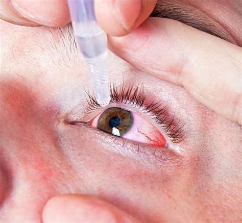 Glaucoma saiba o que é esta doença e como diagnosticar Alto Astral