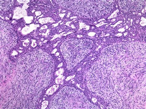 Phyllodes Tumor Low Grade With Epithelial Hyperplasia