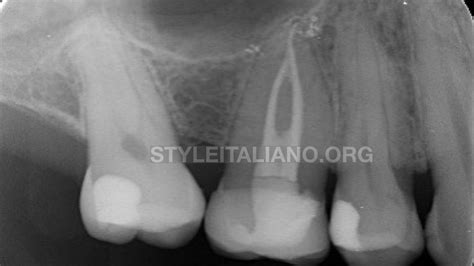 Endo Resto Treatment Management Of Confluent Canals Style Italiano