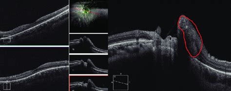 Oct Macula Showing Normal Foveal Contour Oct Disc Showing Subretinal