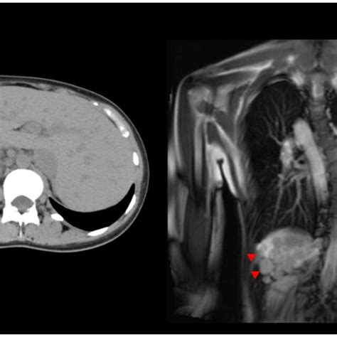 Red Arrow Heads Showing Polysplenia In Abdominal Ct Image Left