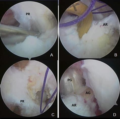 Important Steps In The Reconstruction Of ACL And PCL A The Attachment Download Scientific