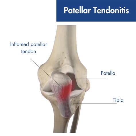 Patellar Tendonitis Madison Wi Pro Spine And Pain