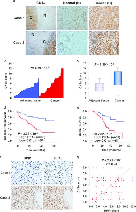 Expression Of Ck1α And Its Correlation With Hpip In Rcc Patients A