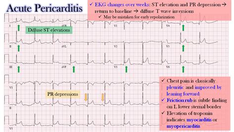 Constrictive Pericarditis Ecg