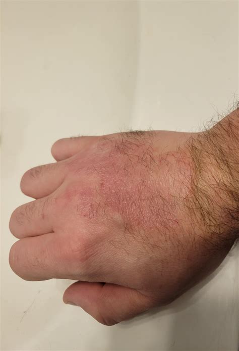 Dry Red Spots For Months Getting Worse Rdermatologyquestions