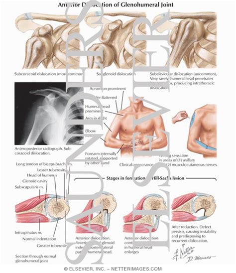 Glenohumeral Joint Dislocation