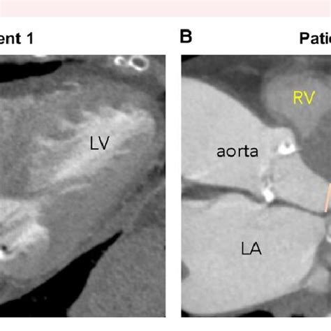 Cardiac Ct Showing Longitudinal Cross Sectional Views Between The