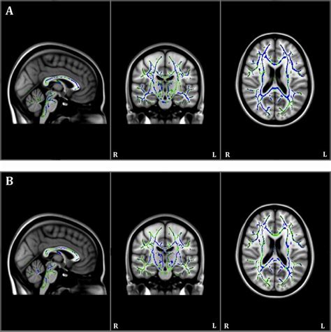 Results Of Within Group Tract Based Spatial Statistics White Matter Download Scientific Diagram