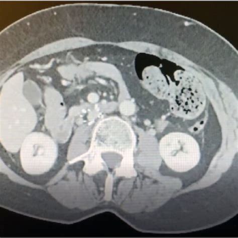 Ivc Strut Penetrating Duodenum Ivc Inferior Vena Cava Download Scientific Diagram