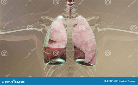 3d Illustration Of Hemothorax Normal Lung Versus Collapsed Symptoms