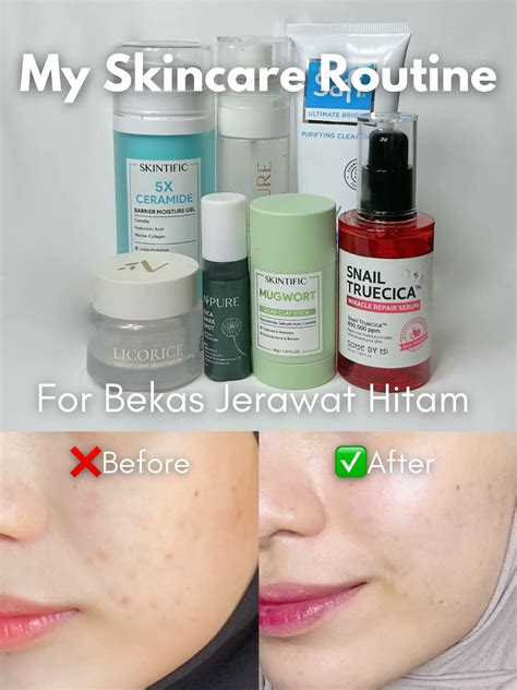 Rekomendasi Skincare Untuk Bekas Jerawat Hitam Bedak Halal