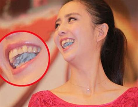 佟丽娅现身发布会，大笑时口中现白色“异物”