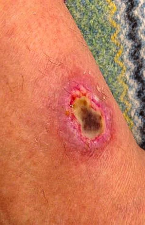 What Do Spider Bites Look Like And Are They Common In The Uk Metro