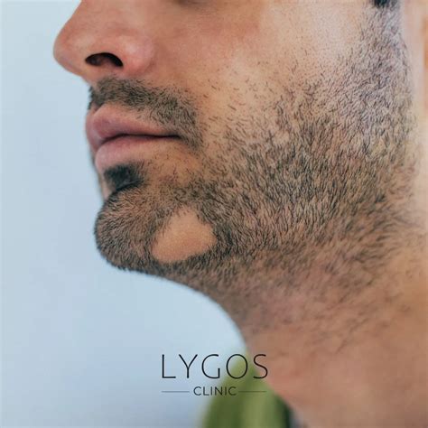How Does A Rash Caused By Shaving Pass Lygos Clinic