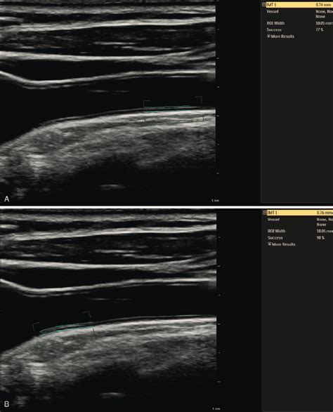Representative B Mode Ultrasound Images Showing The IMT Values Download Scientific Diagram