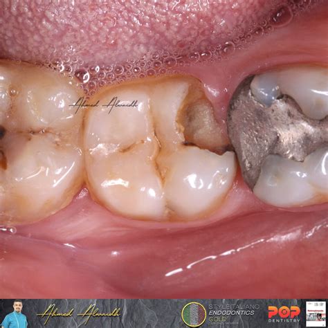 Ahmed Alwaidh Bds Msc Kcl Endo On Linkedin Smile
