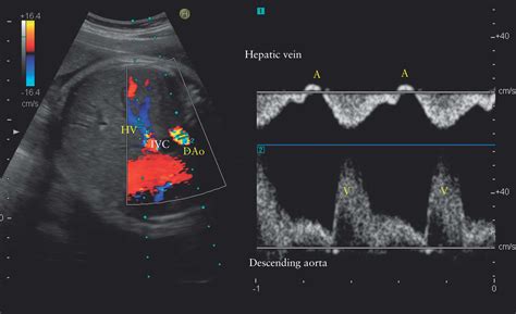 Simultaneous Recordings Of Pulsed Wave Doppler Signals In Hepatic Vein