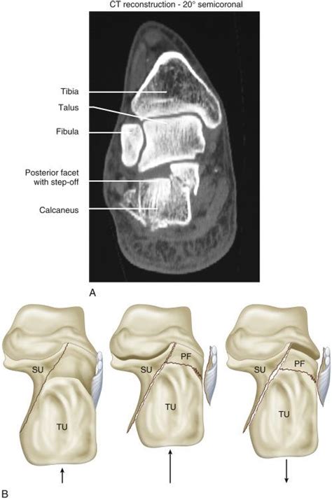 Calcaneus Fractures Treatment Using Extensile Lateral Approach And Open Reduction Internal