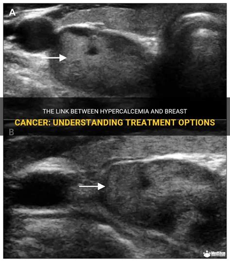 The Link Between Hypercalcemia And Breast Cancer Understanding