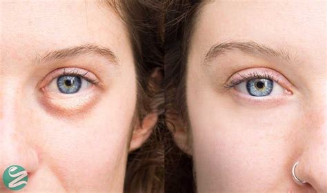 14 روش خانگی از بین بردن پف زیر چشم