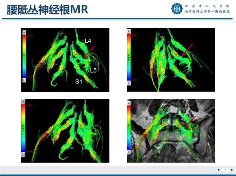 腰骶神经根压迫症的mri评估压迫症神经根评估患者 健康界
