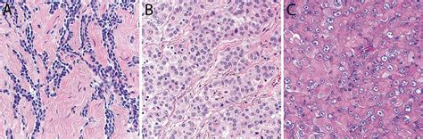 Malignant Peritoneal Mesothelioma Prognostic Significance Of Clinical