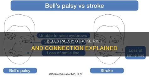 Bells Palsy Stroke Risk And Connection Explained Medshun