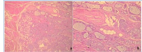 A Adenoid Cystic Carcinoma Formed By Tubular And Cribriform