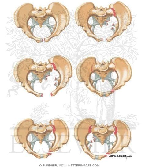 Classification Of Pelvic Fractures Trauma