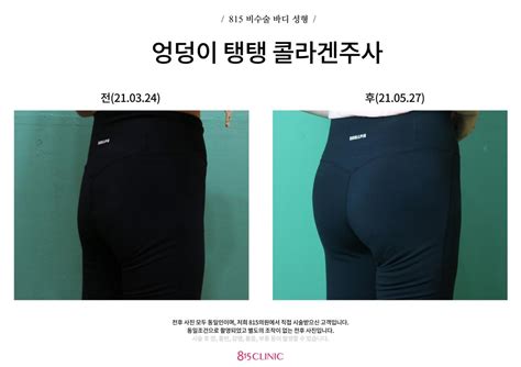 엉덩이 콜라겐 주사 전후사진 815클리닉
