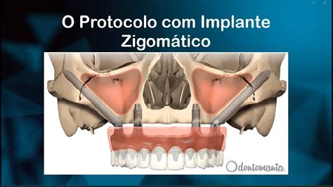 Protocolo Zigomático Youtube