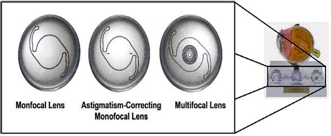 Premium Iol Options Lens Set Gulden Ophthalmics