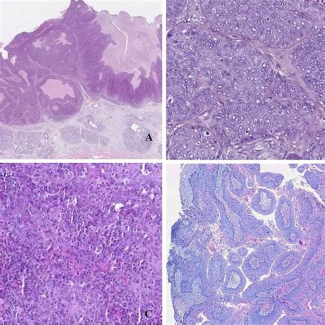 Nasopharyngeal Papillary Adenocarcinoma A Polypoid Formation Covered