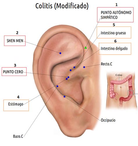 Auriculoterapia Colitis