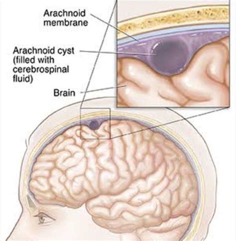 Cause Of Arachnoid Cysts Medizzy