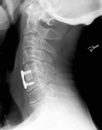 Cervical Myelopathy Dr Arvind Kulkarni