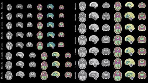 Researchers Create First Fetal Brain Atlas For Spina Bifida Aperta