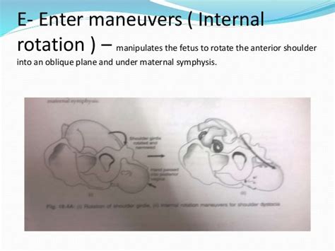 Recent Advances In Shoulder Dystocia Ppt