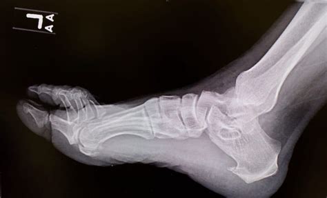 Esporão De Galo Blog Da Saúde